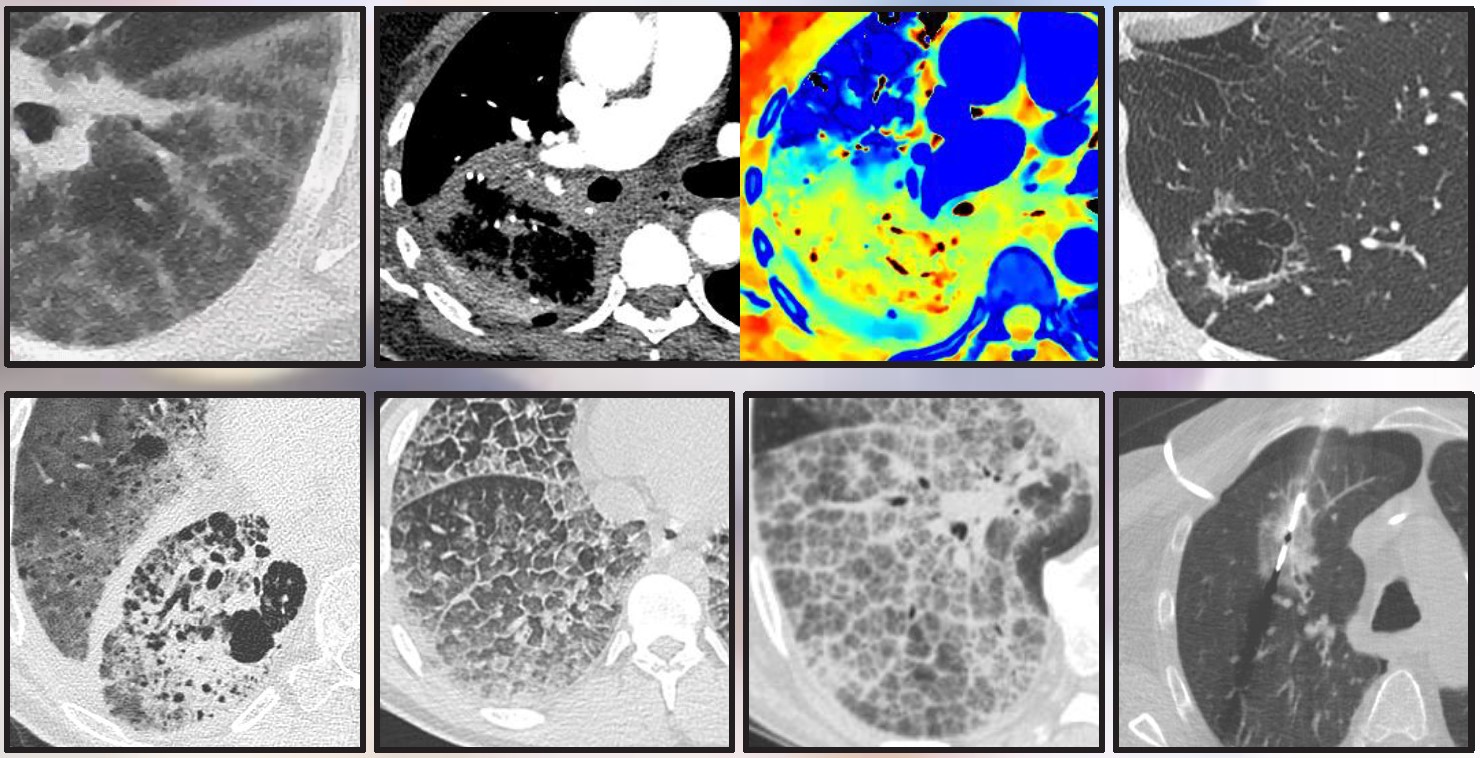 Thoracic Imaging in 2025 : Current Practice and Hot Topics | Radiologic ...
